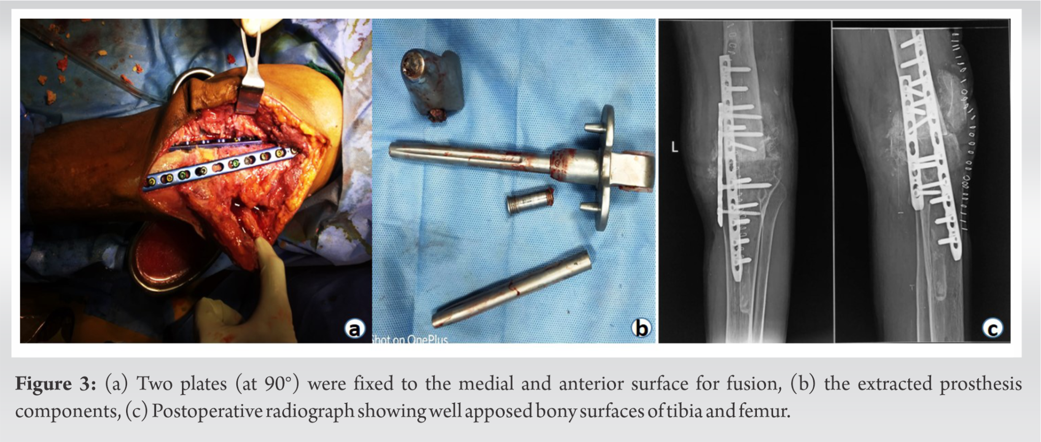 Knee Arthrodesis Using Dual-Plate Construct: An Economically Viable ...