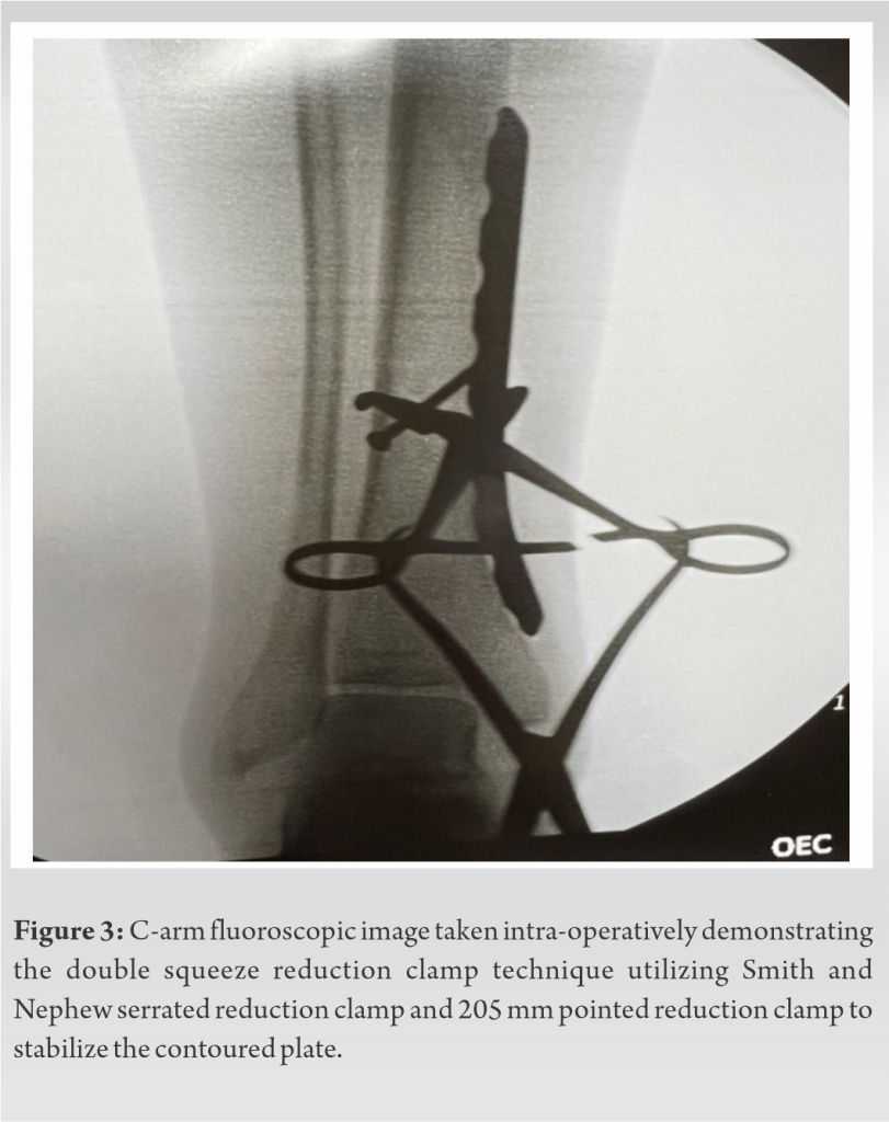 Double Squeeze Reduction Clamp Technique for Fracture Stabilization: A ...