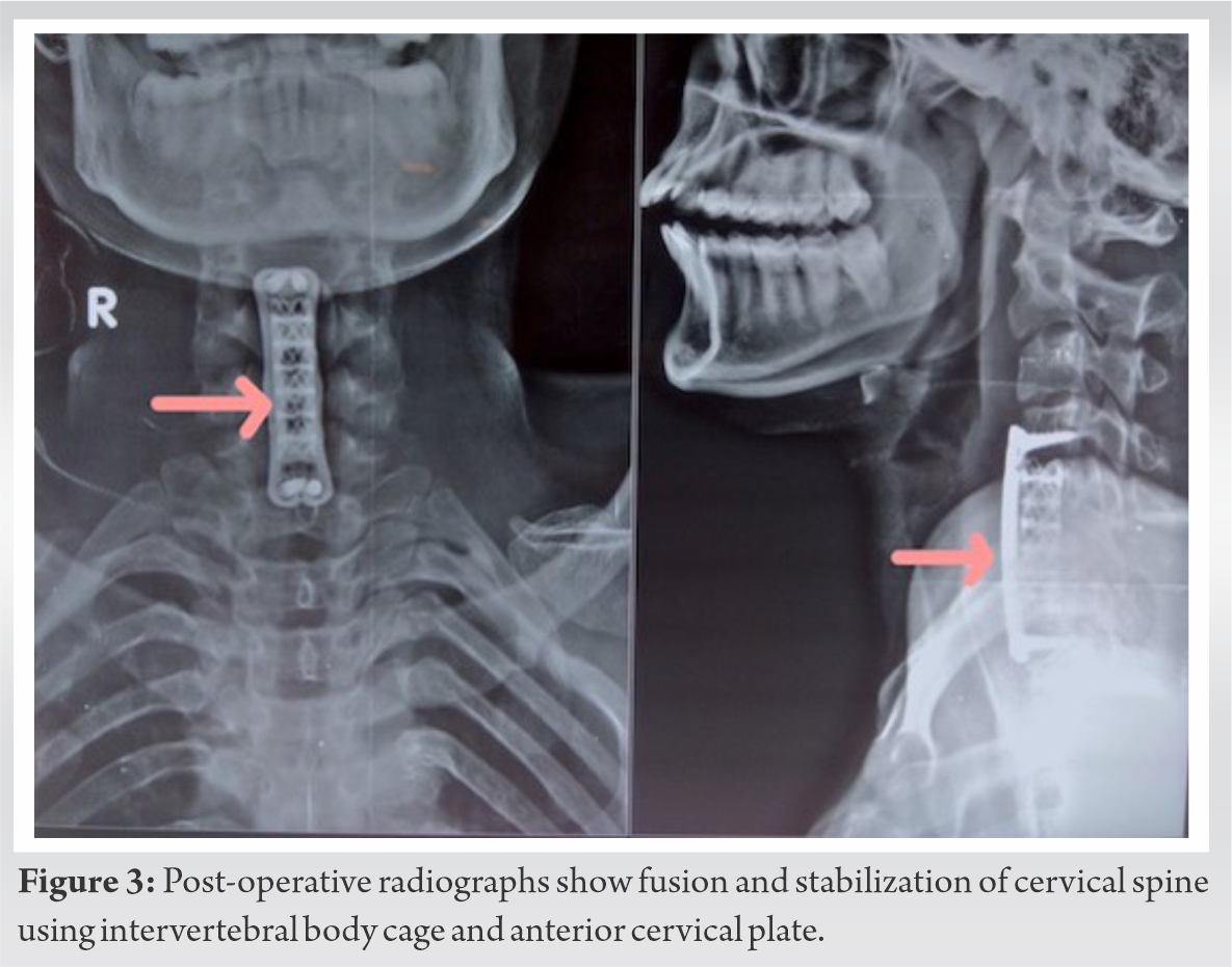 A Unique Presentation of Vertebral Body Osteochondroma of Sixth ...