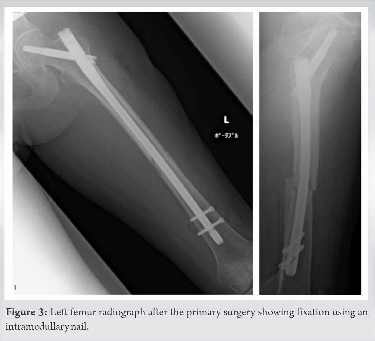 Impending Atypical Femoral Fracture on the Contralateral Side ...