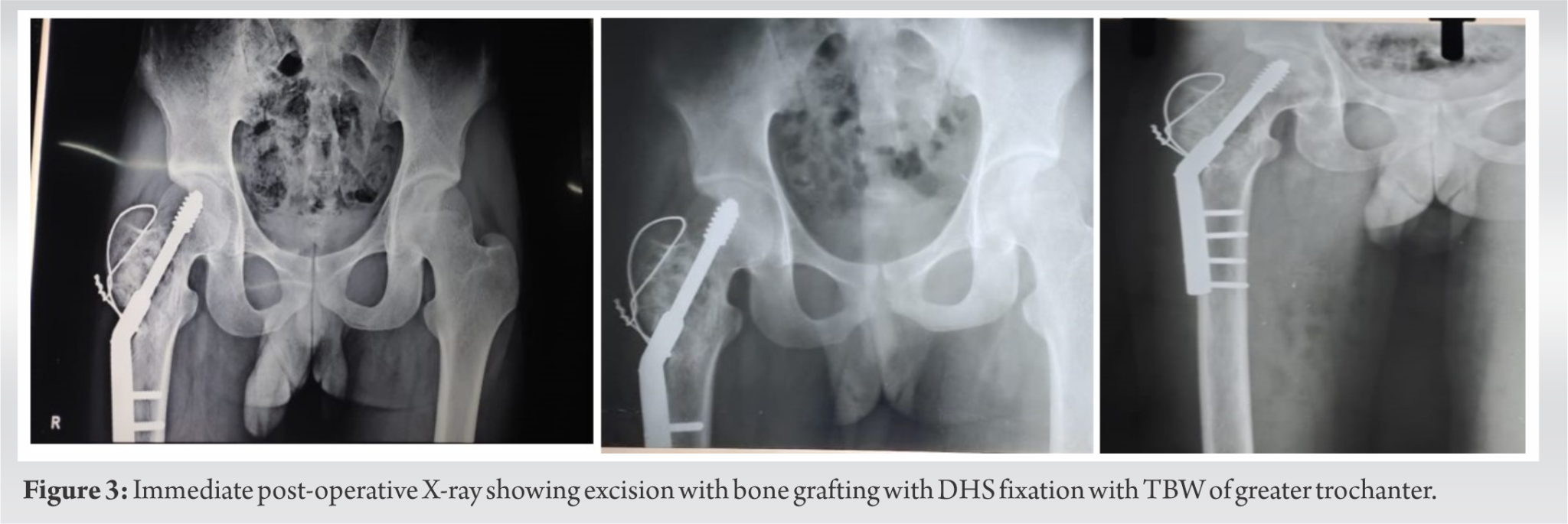 Management of Proximal Femur Aneurysmal Bone Cyst with 10-year Follow ...
