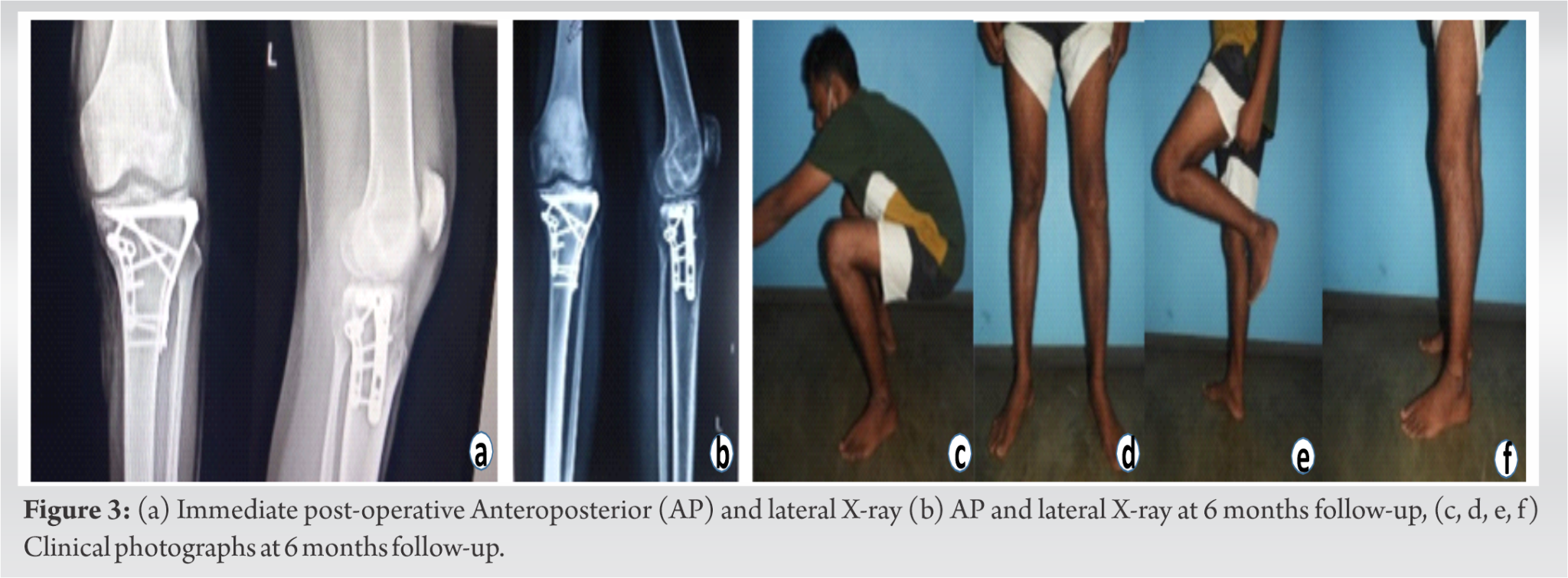 A Unique Upside-down Flip-lid Type of Lateral Tibial Plateau Fracture ...
