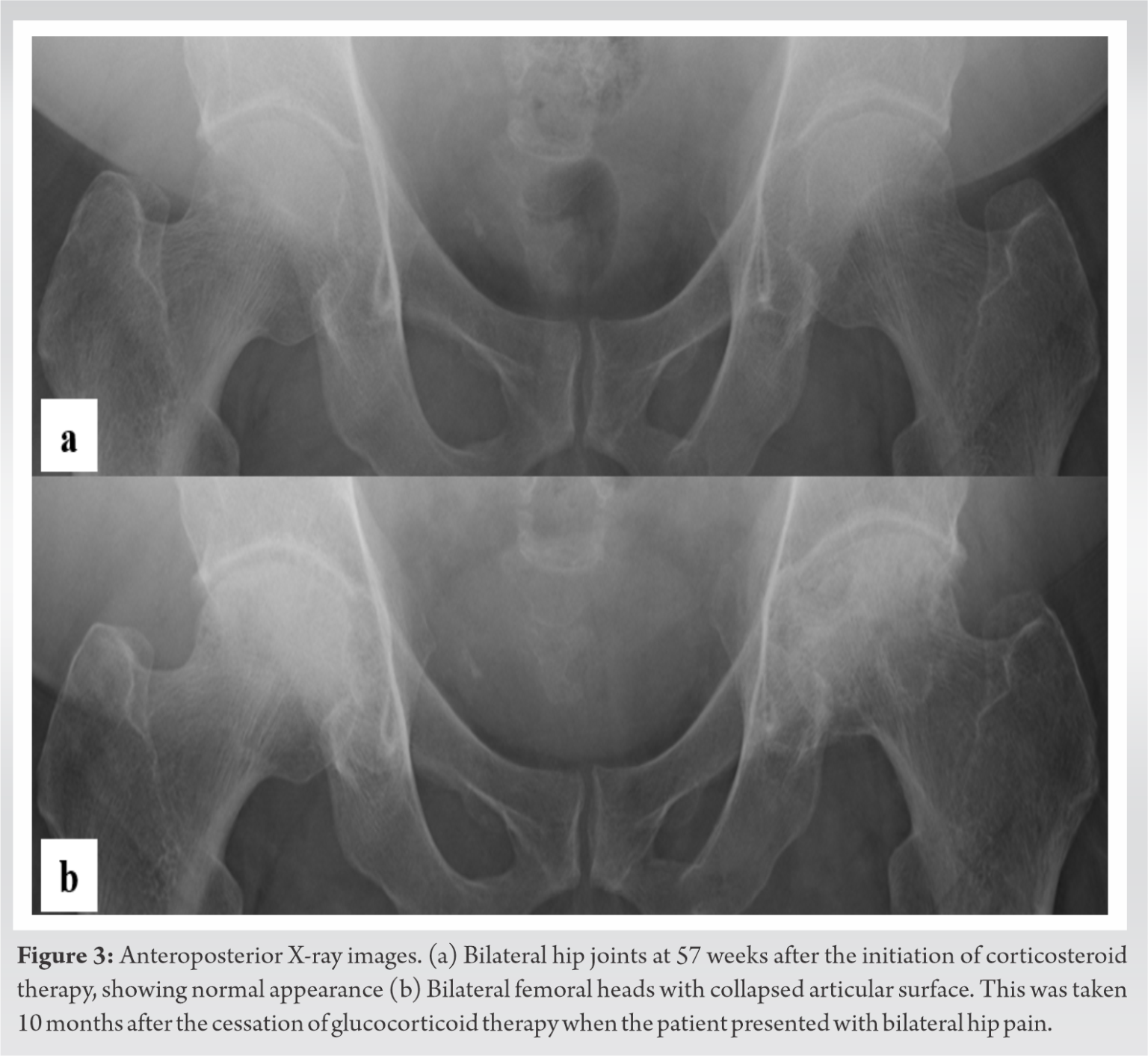Immune-related Adverse Event with Checkpoint Inhibitors Might Be an ...