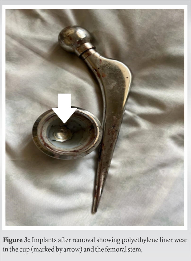 Eccentric Wear of Polyethylene Liner in a Bipolar Hemiarthroplasty ...