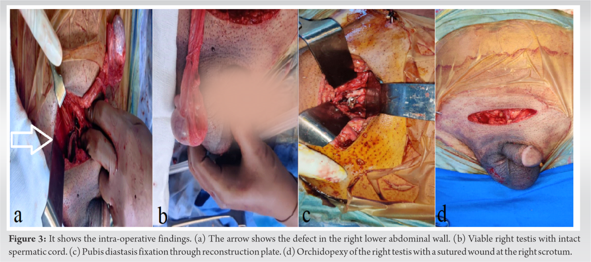 Unilateral Traumatic Testicular Dislocation in a Patient of Pelvic ...