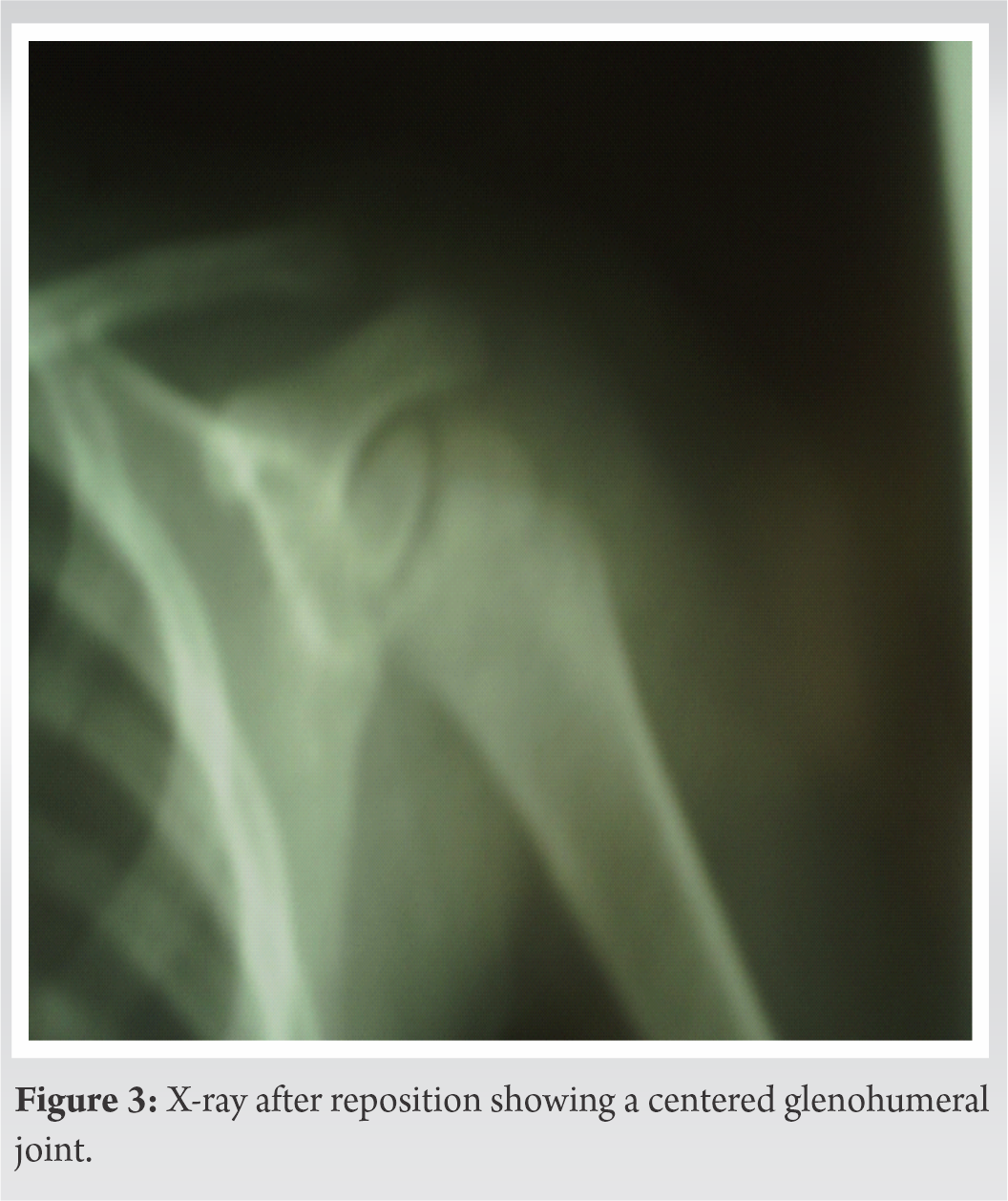 Traumatic Shoulder Dislocation in a Child: A Case Report | Journal of ...