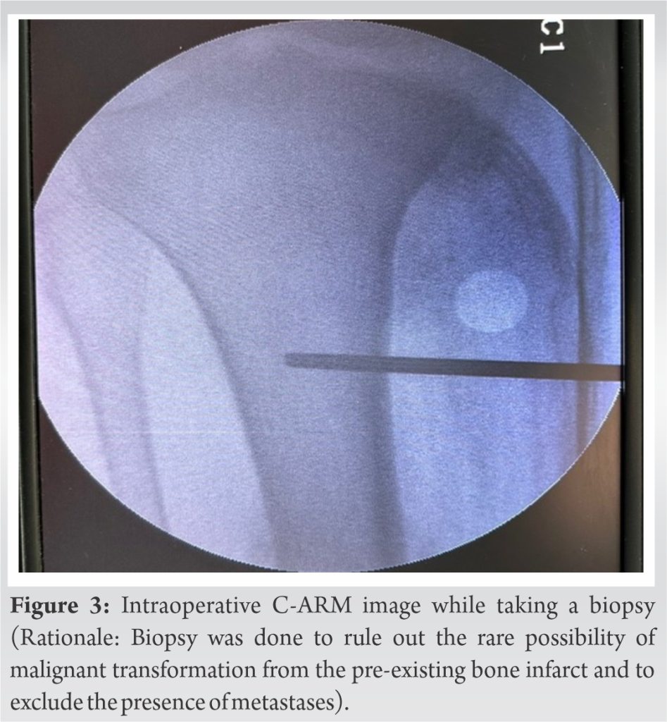 Avascular Necrosis of Proximal Tibia Associated with Pathological ...
