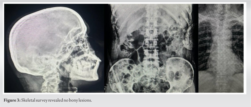 Atypical Presentation of Multiple Myeloma Affecting Appendicular ...
