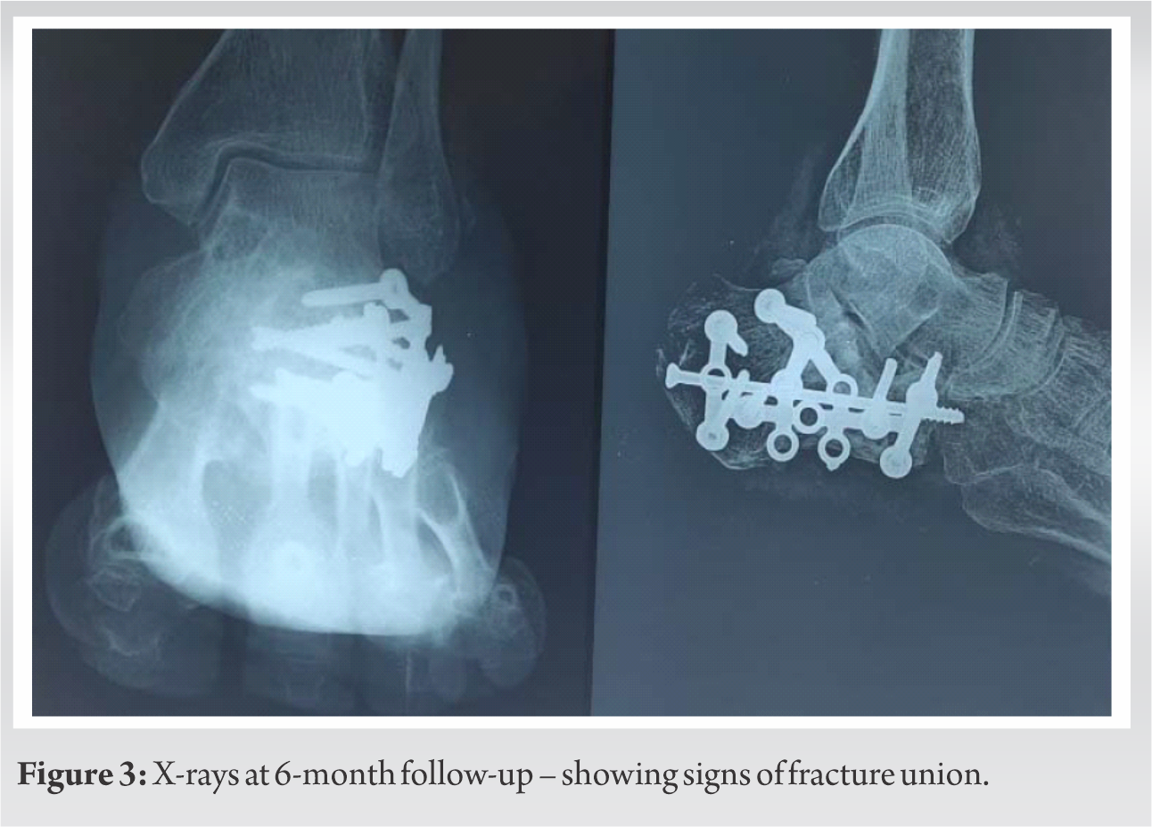 Functional and Radiological Outcome after Internal Fixation of Intra ...