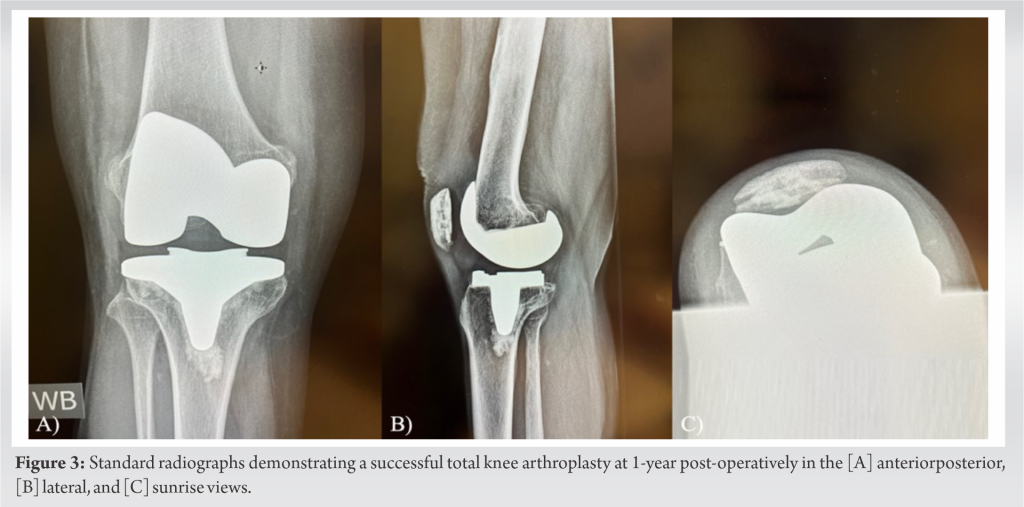 Skin Necrosis after Total Knee Arthroplasty Treated with Eschar ...