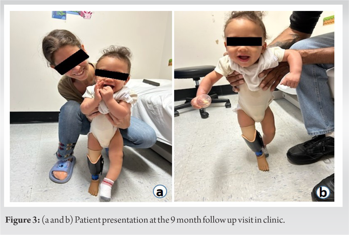 Club Foot with Contralateral Congenital Amniotic Band Syndrome ...
