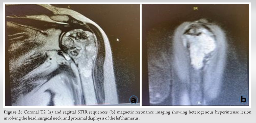 Chondrosarcoma in Proximal Humerus: The First Reported Case in Lebanon ...