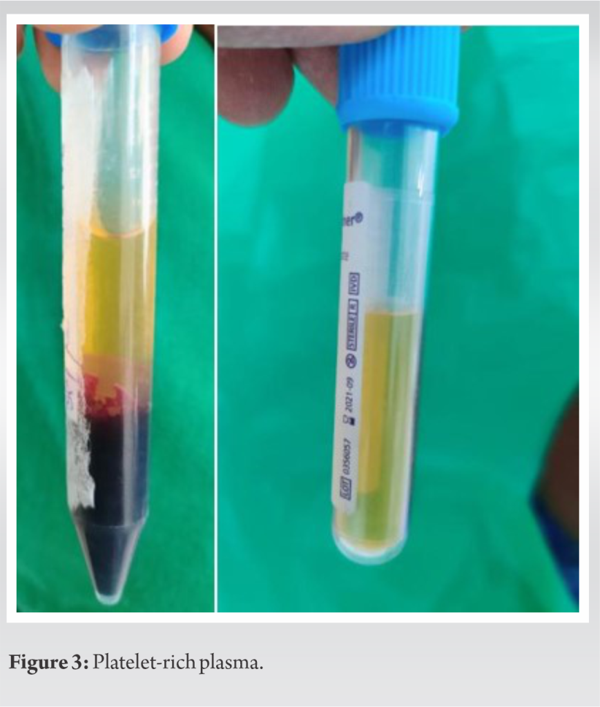 Lateral Epicondylitis Treated with Platelet-Rich Plasma Injection and ...