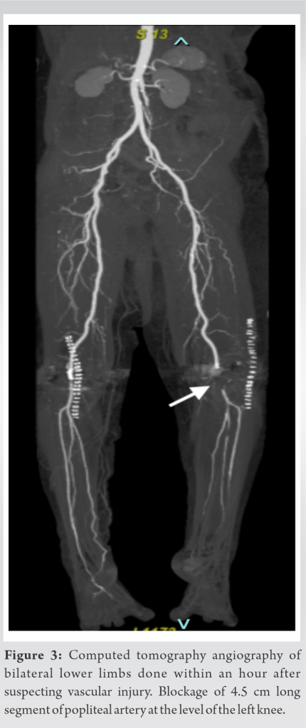 Vascular Injury during Total Knee Replacement and Check List to Follow ...