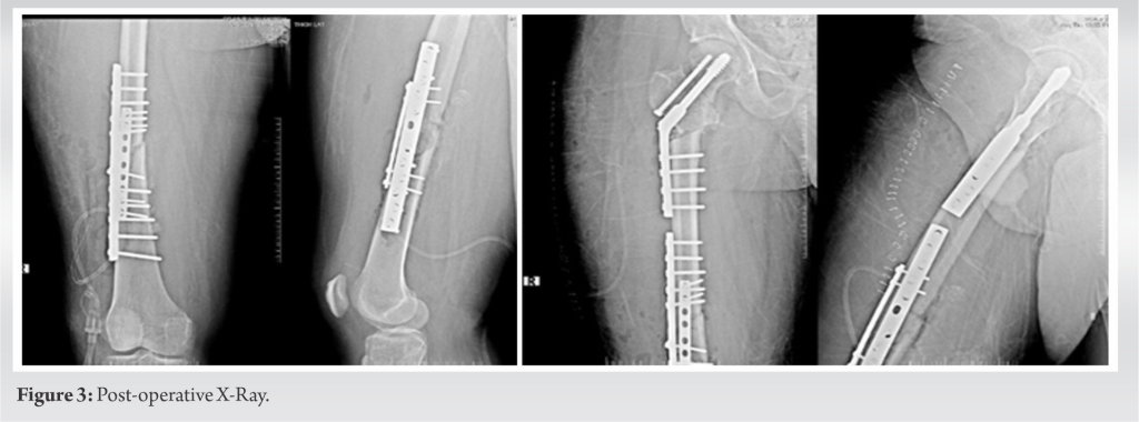 Neglected Ipsilateral Non-Union Neck of Femur with Shaft of Femur Non ...