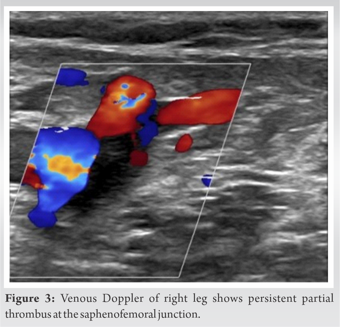 DVT with Pulmonary Embolism in Patient with Grade 2 Compound Tibia ...
