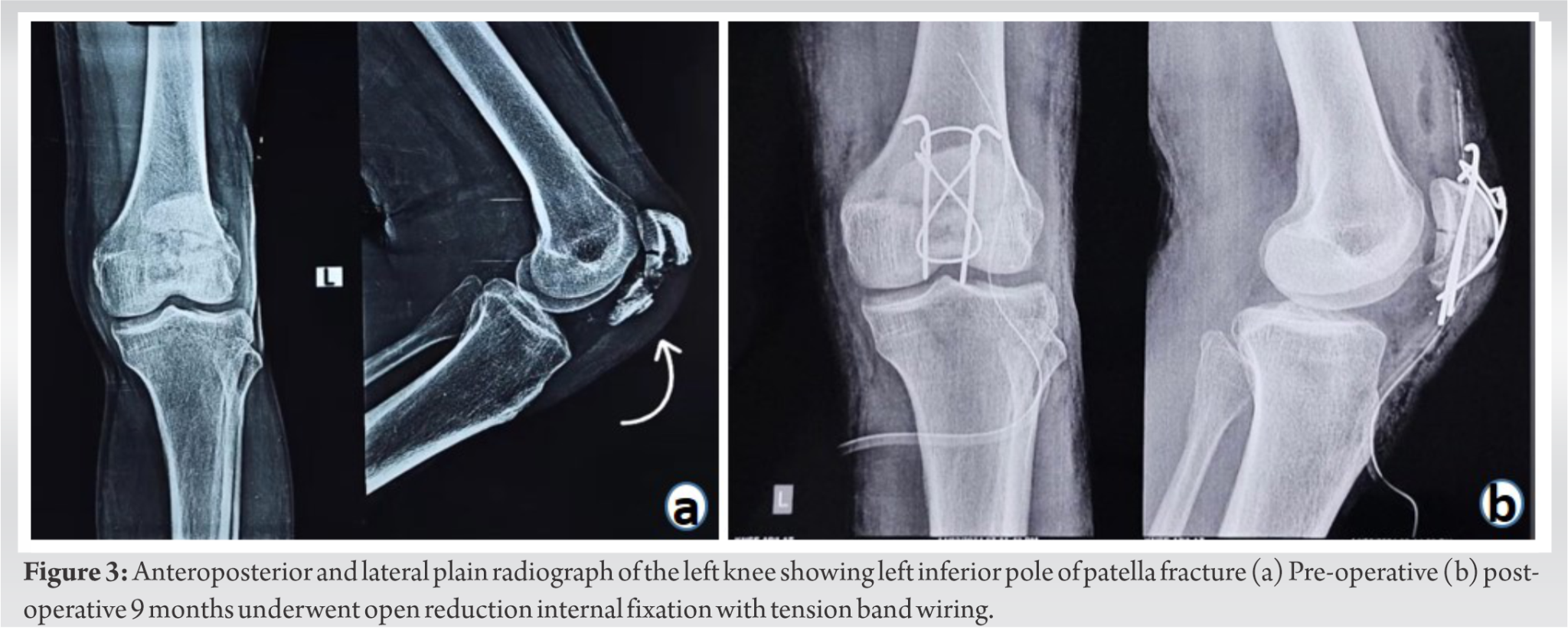 Comparative Study of Inferior Pole of Patella Fracture Treated with ...