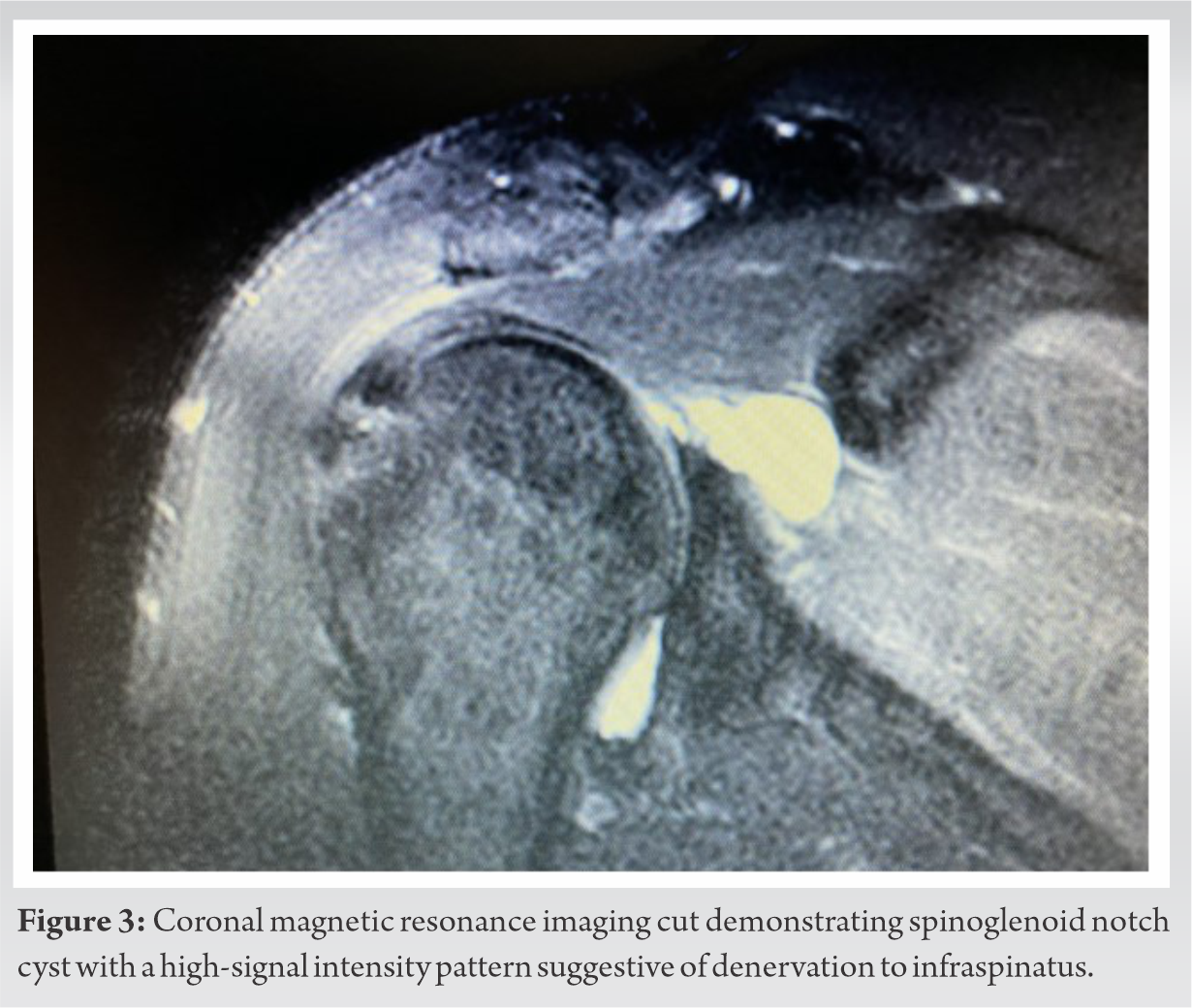 Paralabral Cysts with Associated Infraspinatus and Teres Minor ...