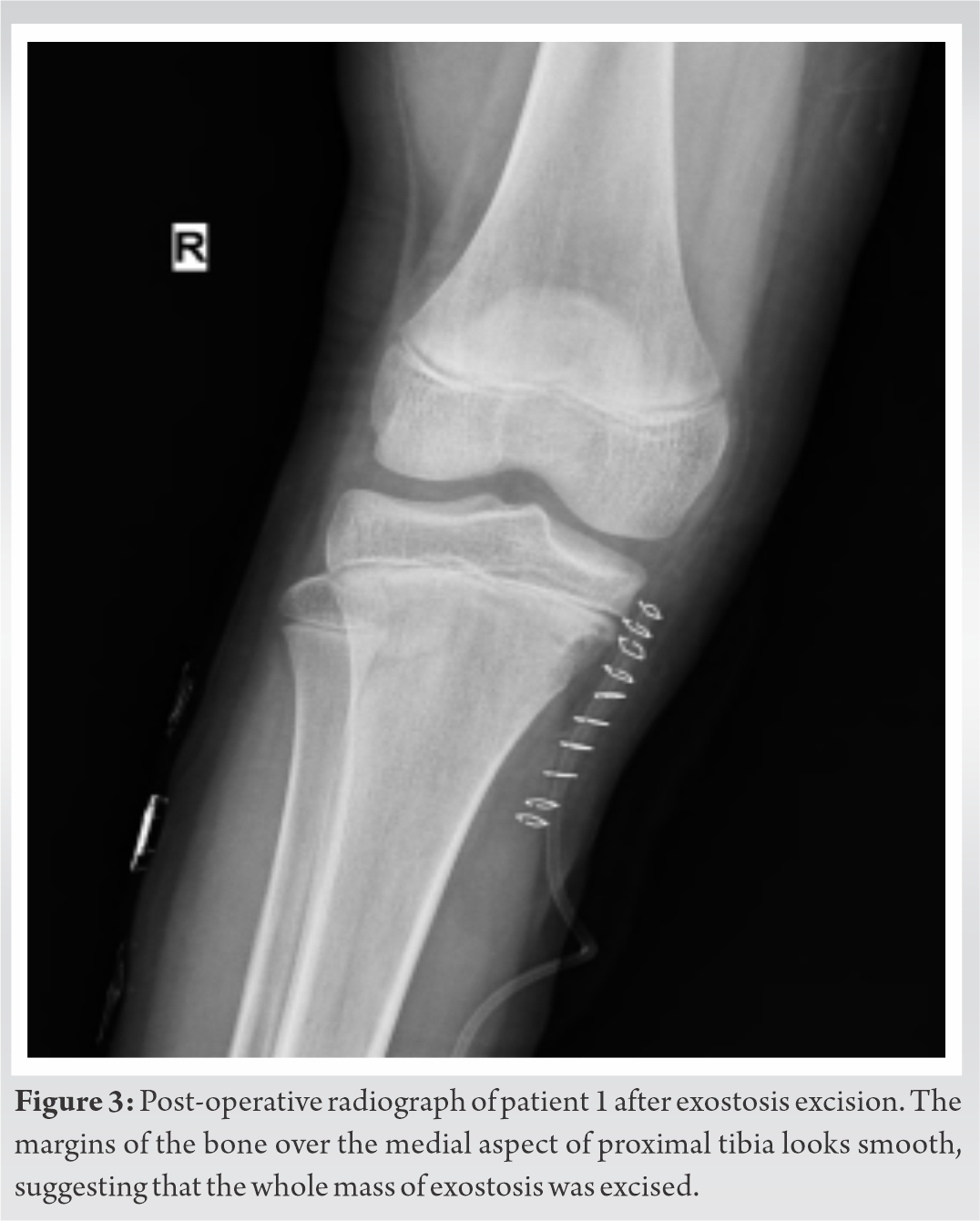 Beyond Hemostasis: Understanding the Risks of Bone Wax in Orthopedic ...
