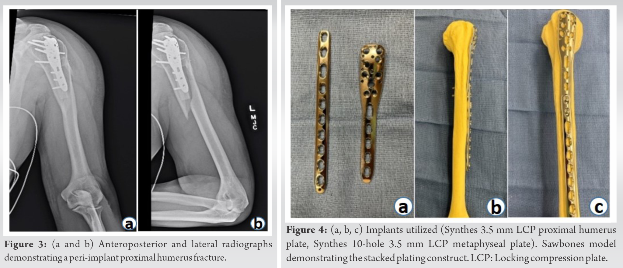 Peri-implant Proximal Humerus Fracture Stabilized with Stacked Plating: A Case Report | Journal ...