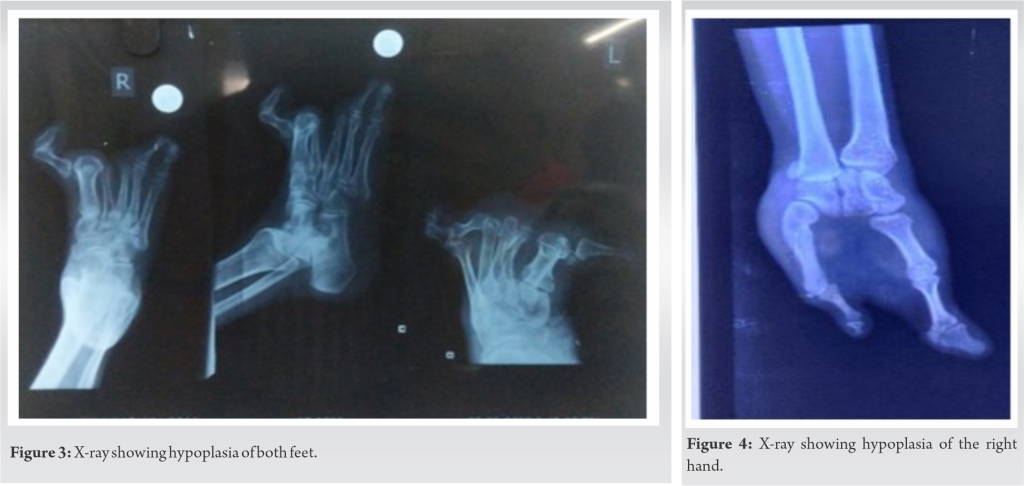 A Rare Case Report of Split Hand and Foot Malformation | Journal of ...