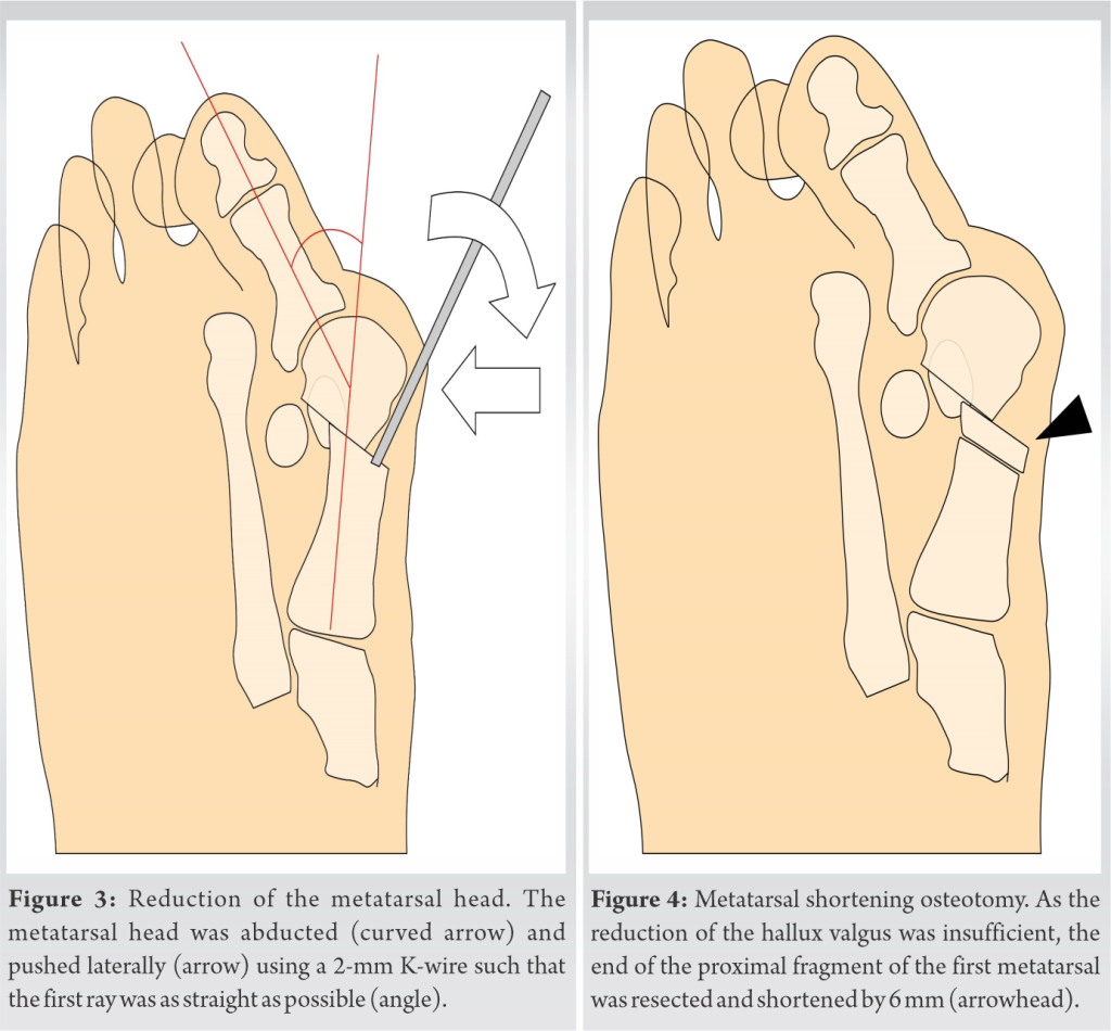 Distal Metatarsal and Proximal Phalangeal Osteotomies without Soft ...