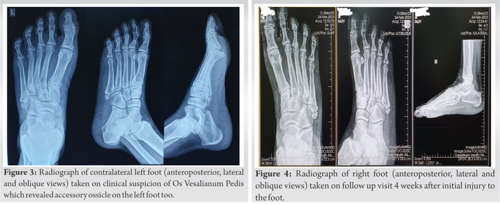 Red Herring in Orthopedics: A Case Report on Painful Os Vesalianum ...