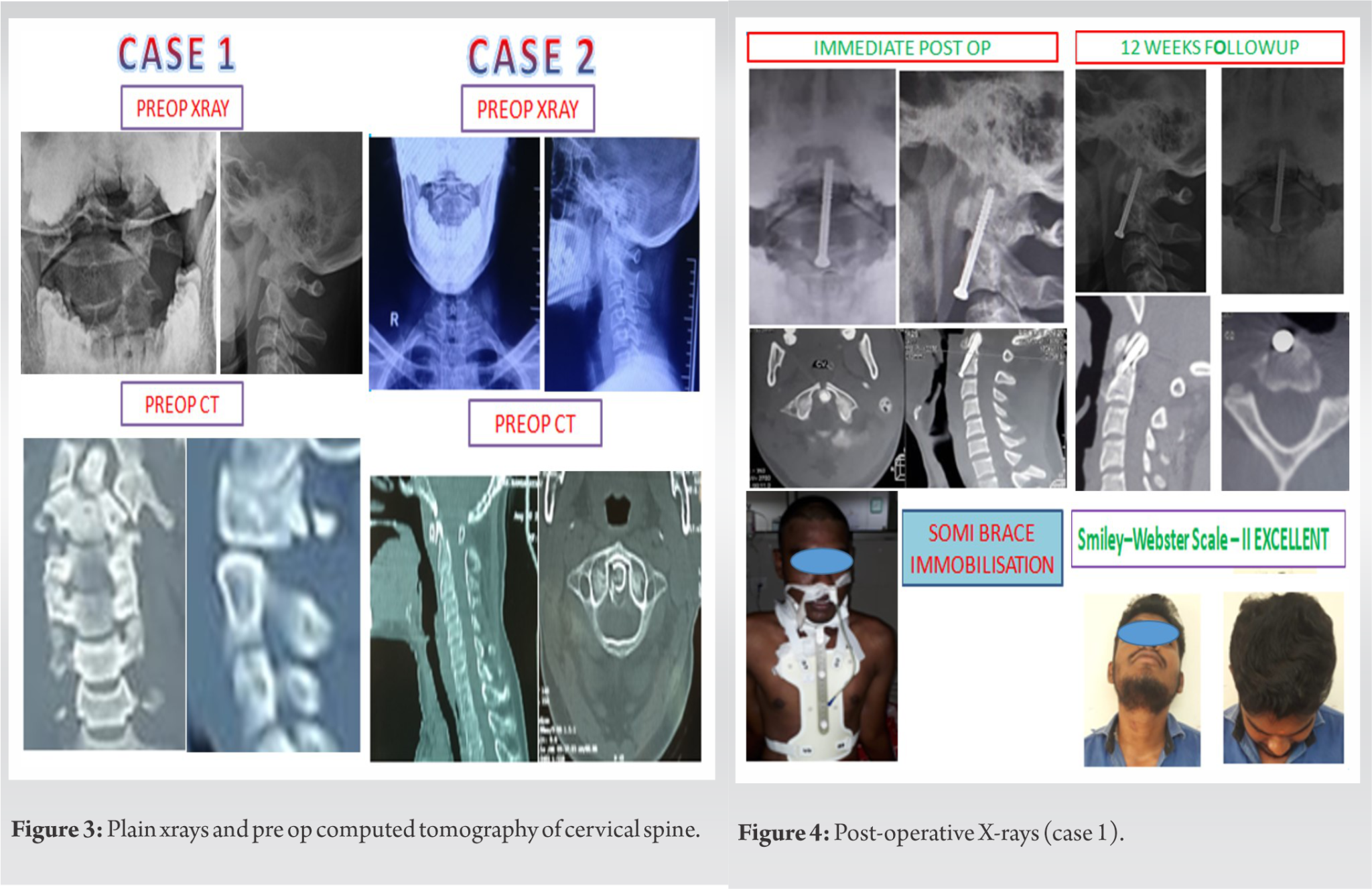 Anterior Screw Fixation for Odontoid Fractures – A Case Series ...