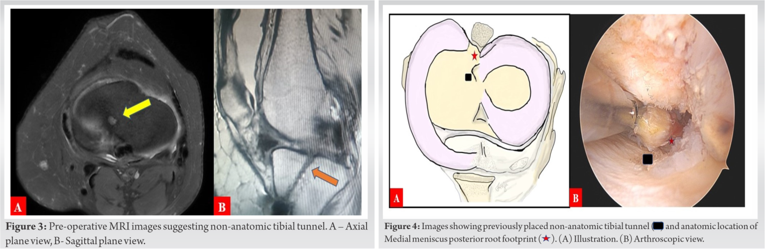 Revision of Failed Medial Meniscus Posterior Root Repair: A Case Report ...