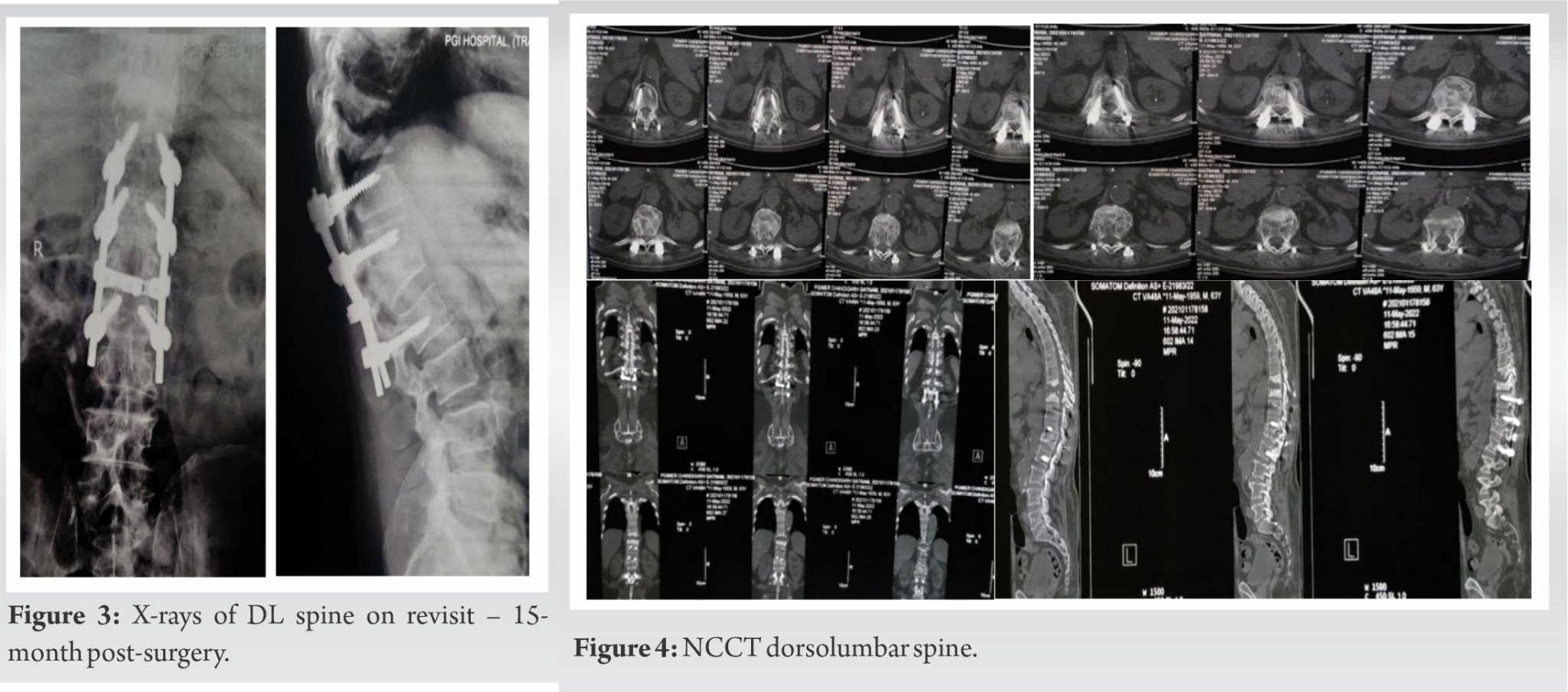Subjacent Disease in an Operated Case of Spinal Tuberculosis: A Case ...