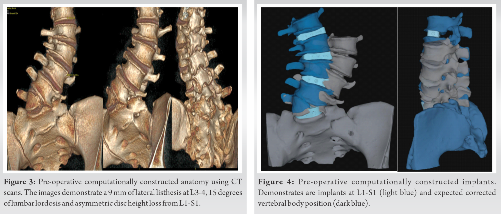 Multilevel Customized 3D-Printed Titanium Alloy Interbody Cages used to ...