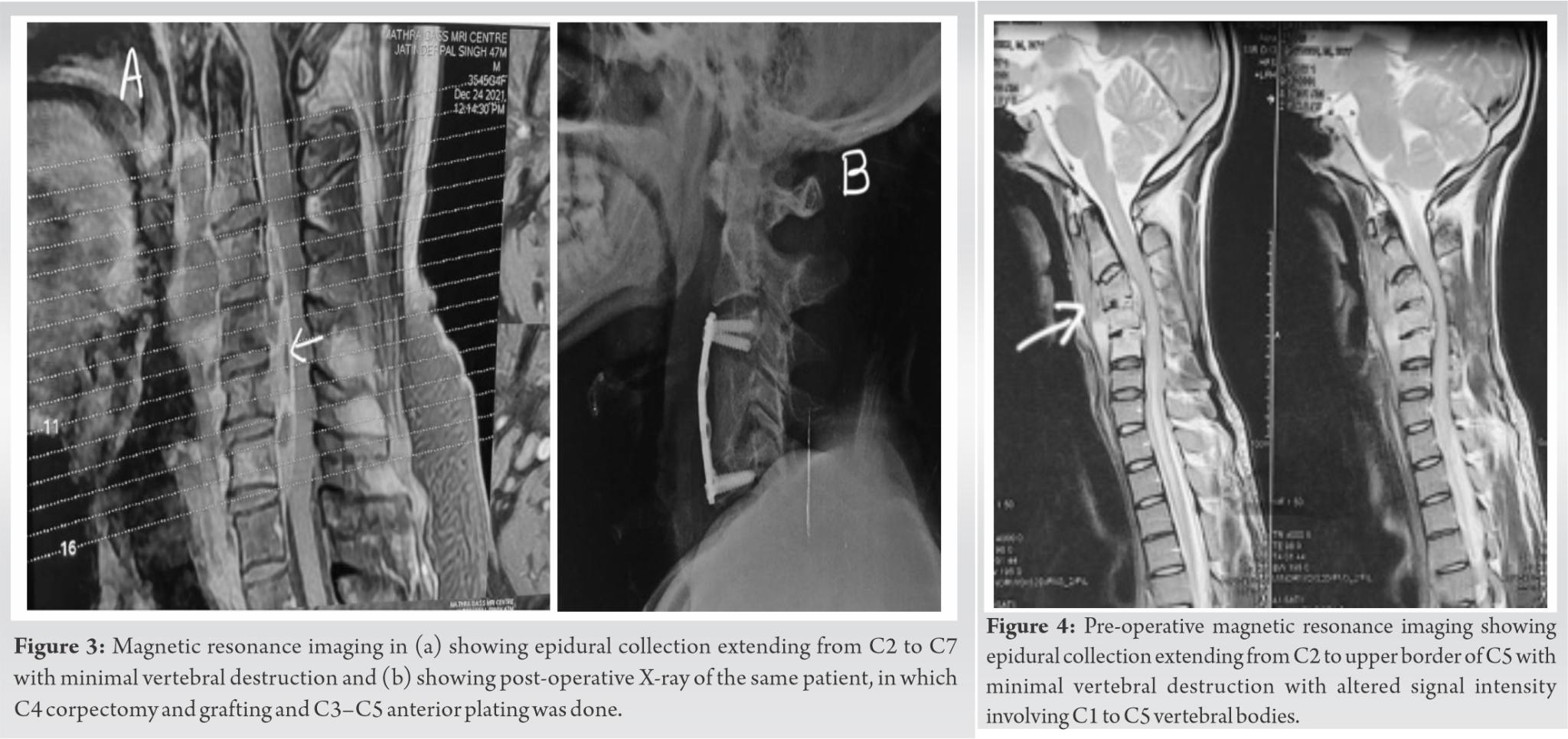Atypical Cervical Potts Spine with Multiple Level Epidural Collection ...