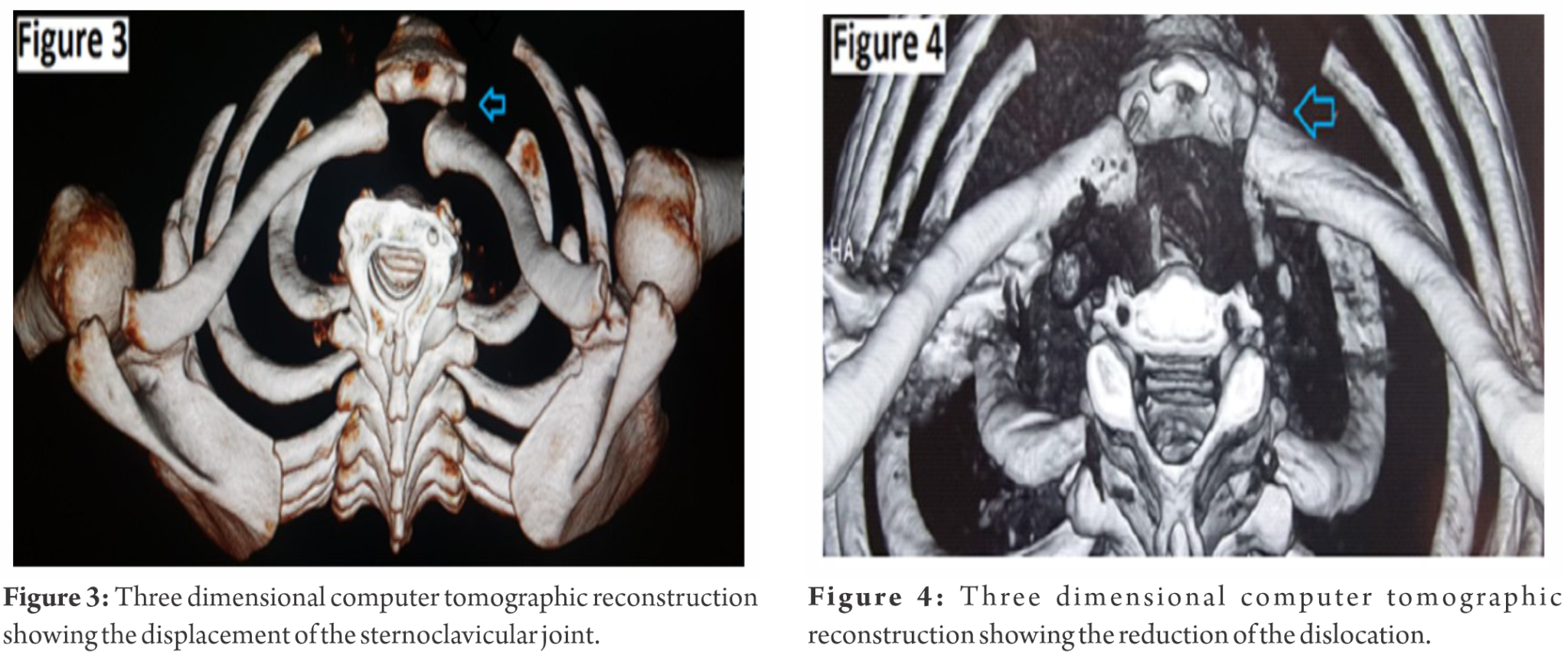 Posterior Sternoclavicular Dislocation in Children: A Case Report ...