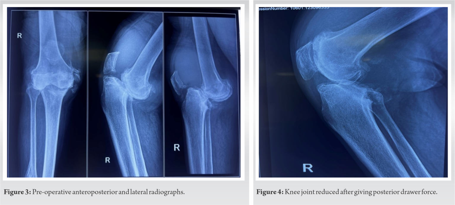 Total Knee Arthroplasty in a Patient with Secondary Osteoarthritis Knee ...