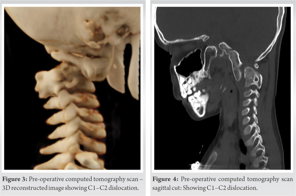 A Rare Case of Grisel’s Syndrome in A 6-Year-Old Child | Journal of ...