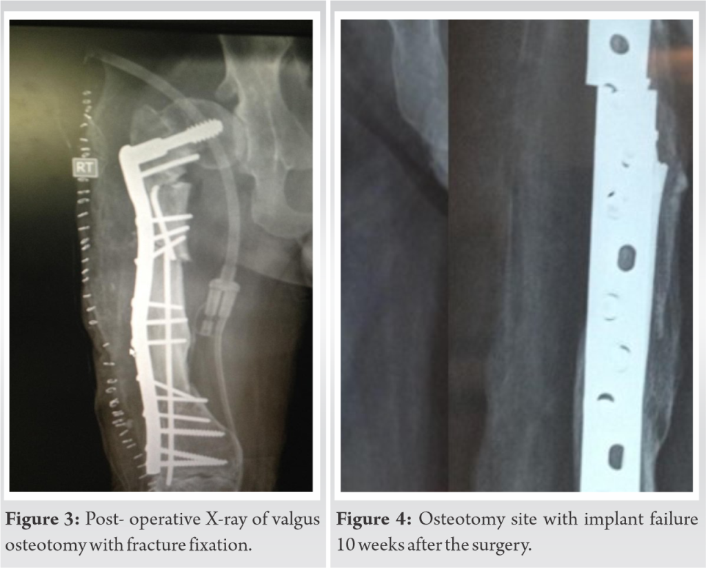 A Closer Look at Fibrous Dysplasia Femur Fracture Five-year Follow-up ...