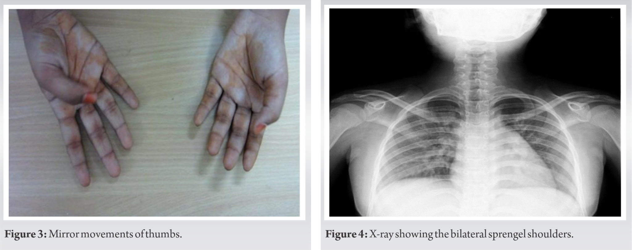 Bilateral Sprengel Deformities, Mirror Movements Synkinesis, and ...