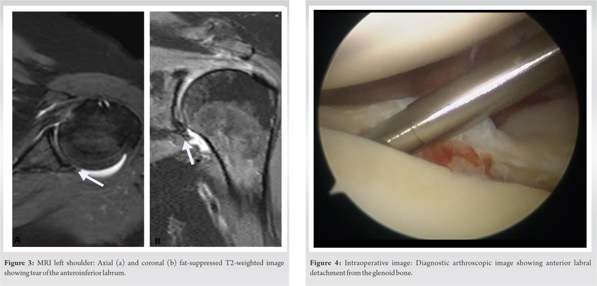Comprehensive Evaluation and Arthroscopic Management of Circumferential ...