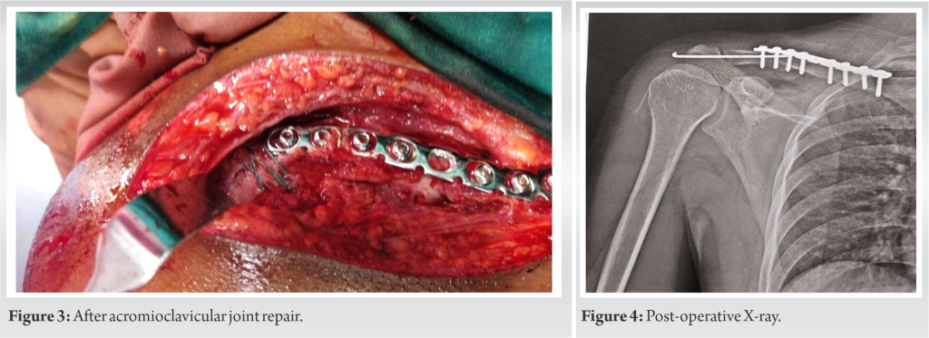 Mid-shaft Clavicle Fracture with Disguised Ipsilateral Type IV ...