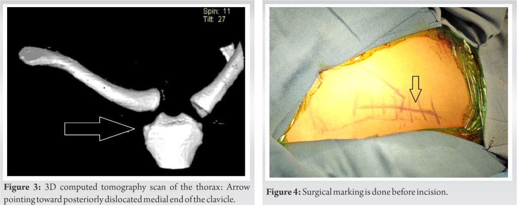 Case Report: Medial Clavicle Physeal Injury Mimicking a Posterior ...