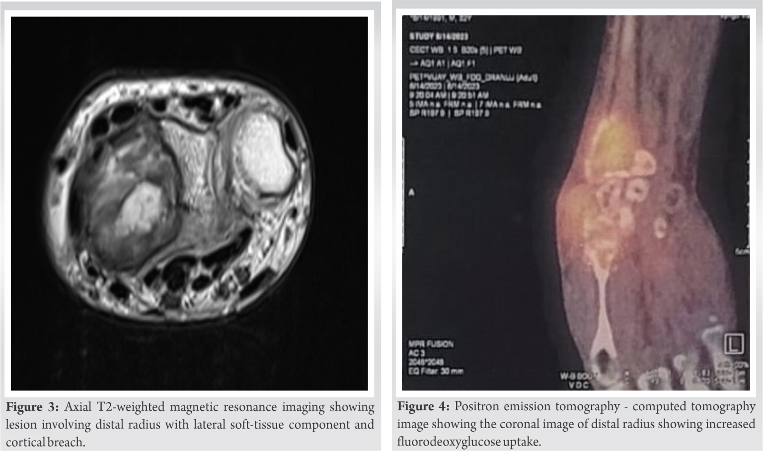 Multifocal Epitheloid Hemangioma of the Bone – A Rare Entity | Journal ...