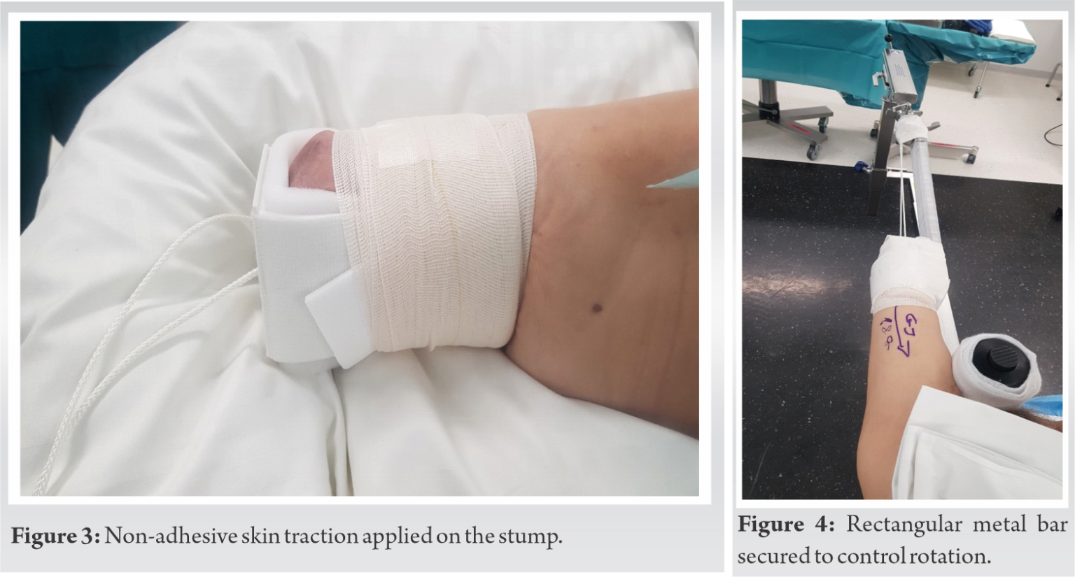 A new non-invasive method for positioning a below-knee amputee with an ...