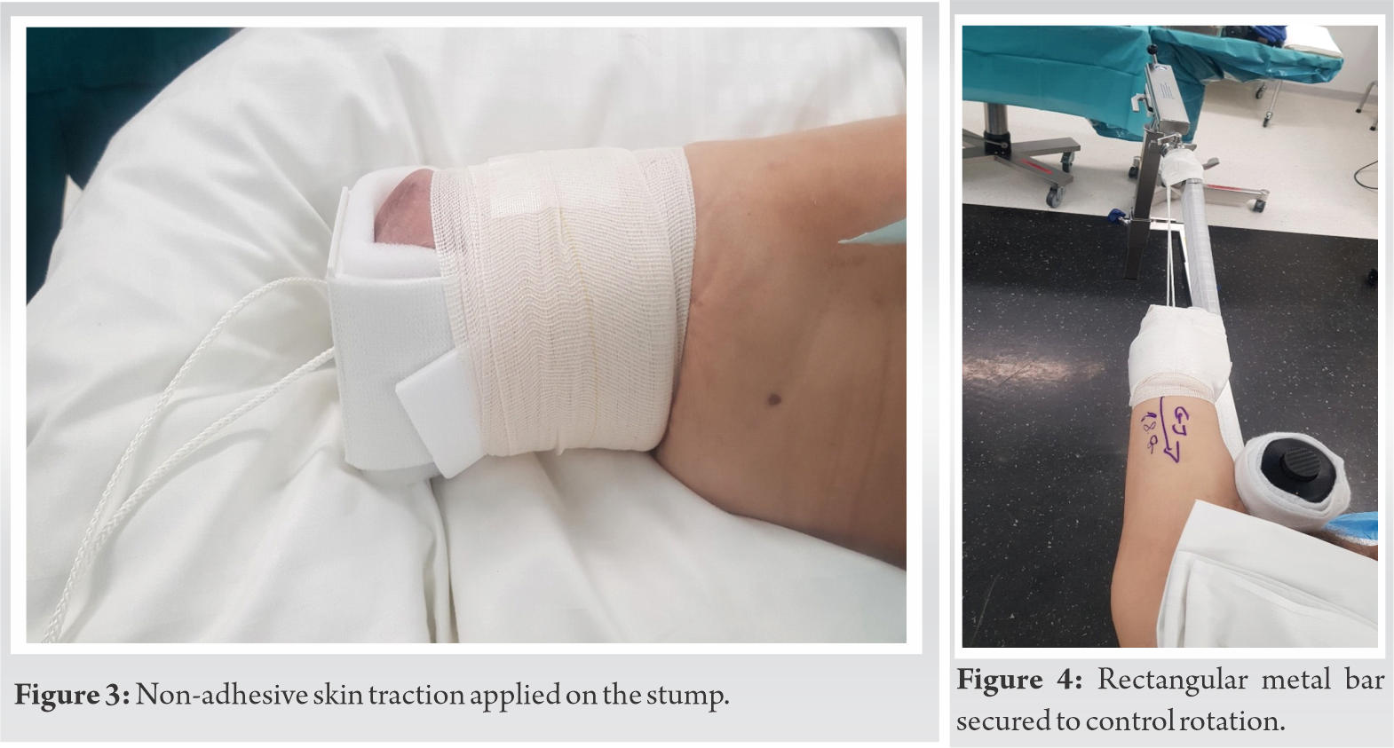 A new non-invasive method for positioning a below-knee amputee with an ...