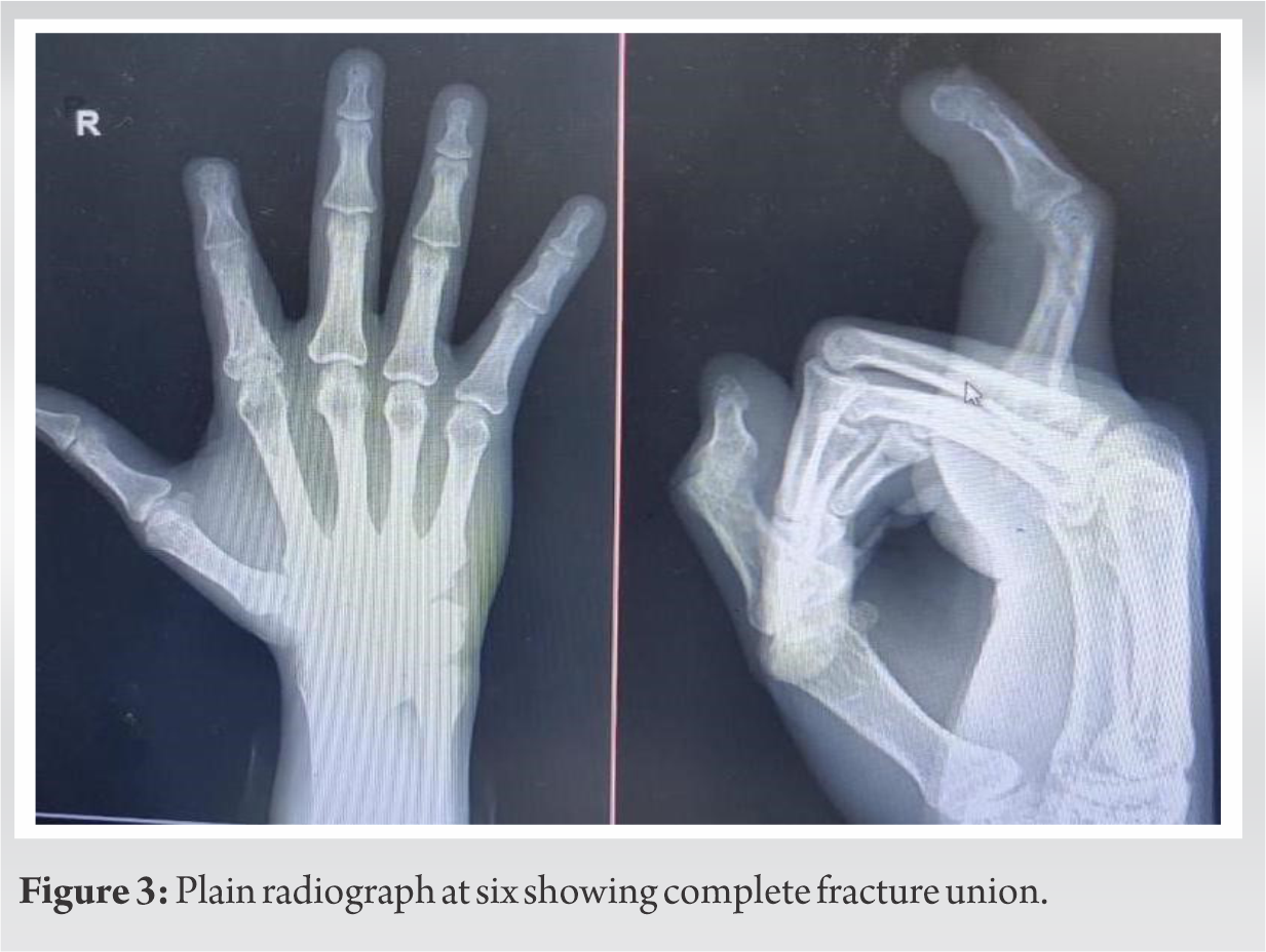 Needle Cap External Fixator for Proximal Phalanx Fracture – A Case ...