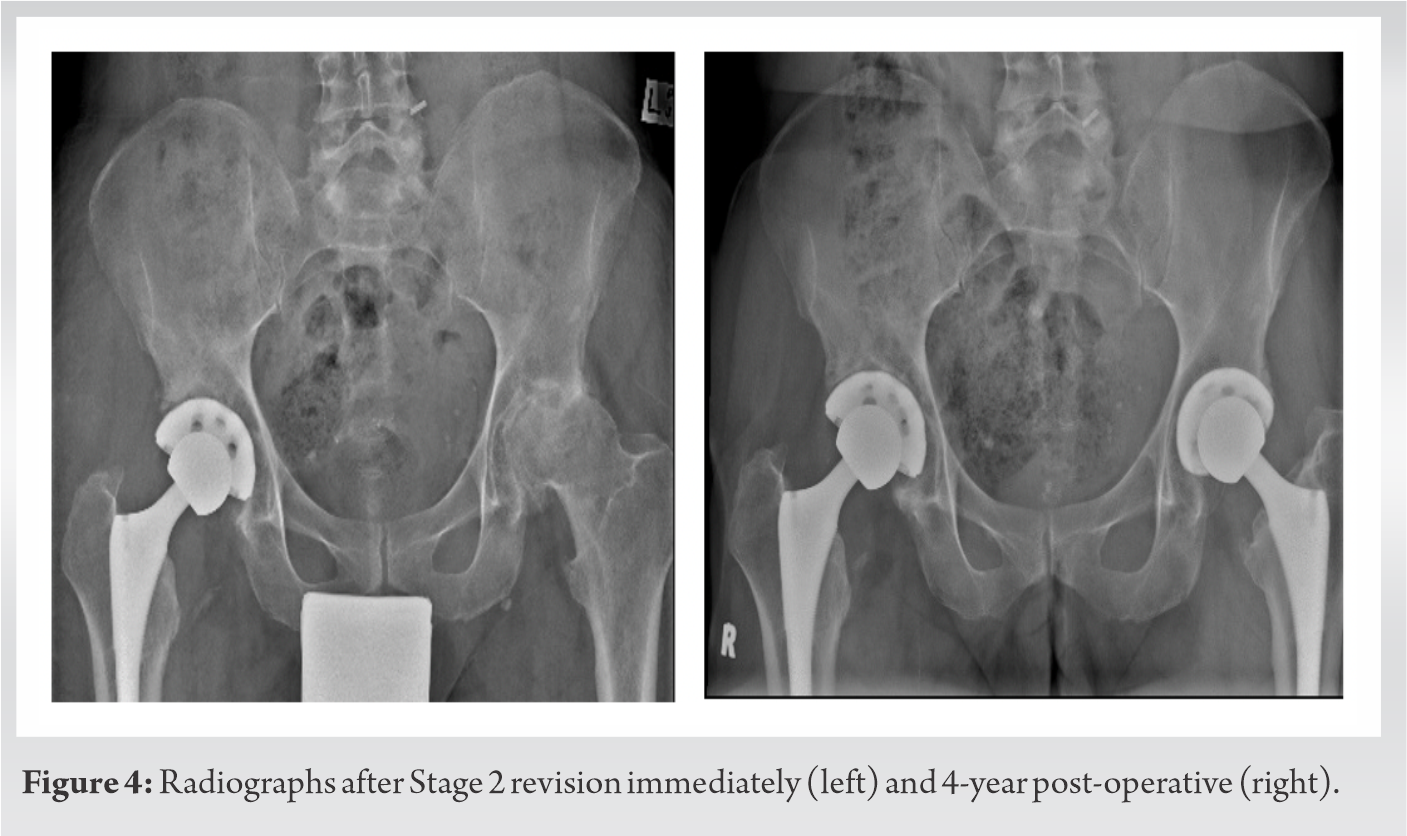 Two-stage Partial Component Retention and Interim Cemented Liner for ...