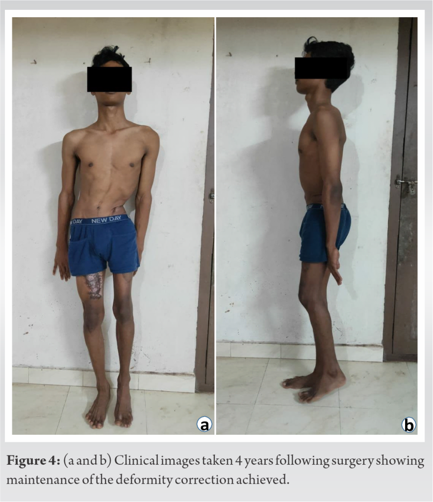 Recurrent Abdominal Aggressive Fibromatosis with Incapacitating Hip ...