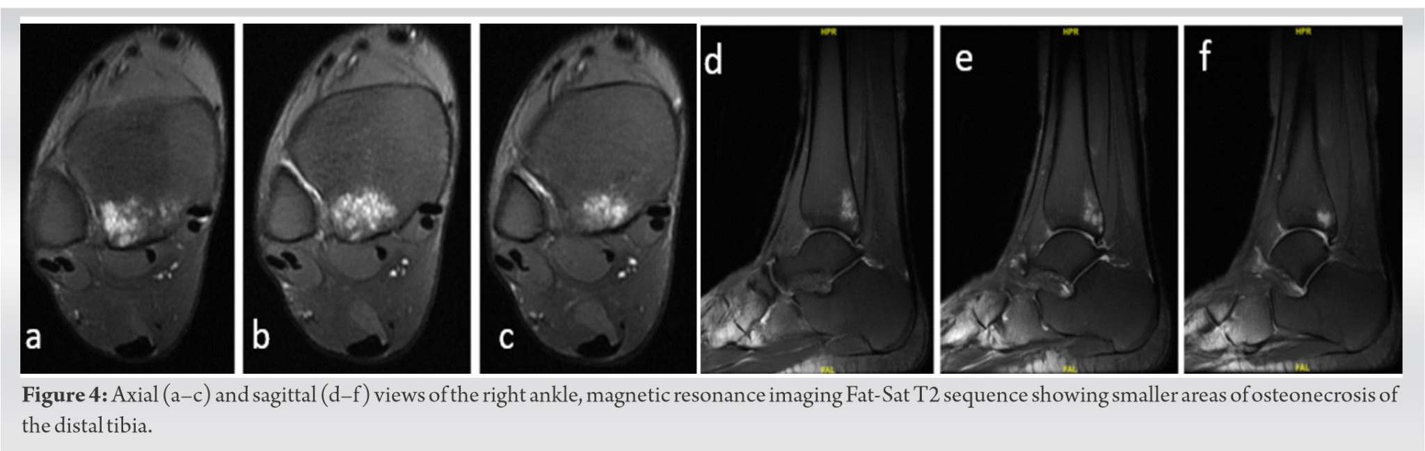 Joint-preserving Surgery for Idiopathic Bilateral Osteonecrosis of the ...