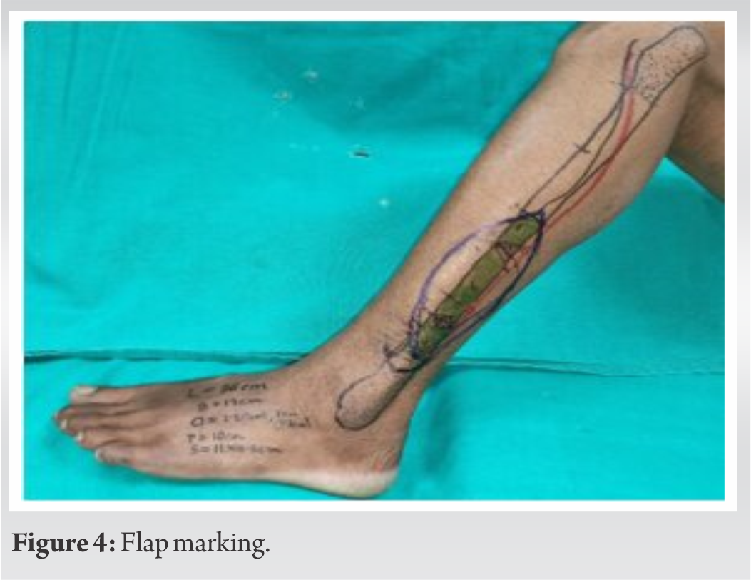 The “Lost” Peroneal Vessel – A Rare Anatomical Variation in Free Fibula ...