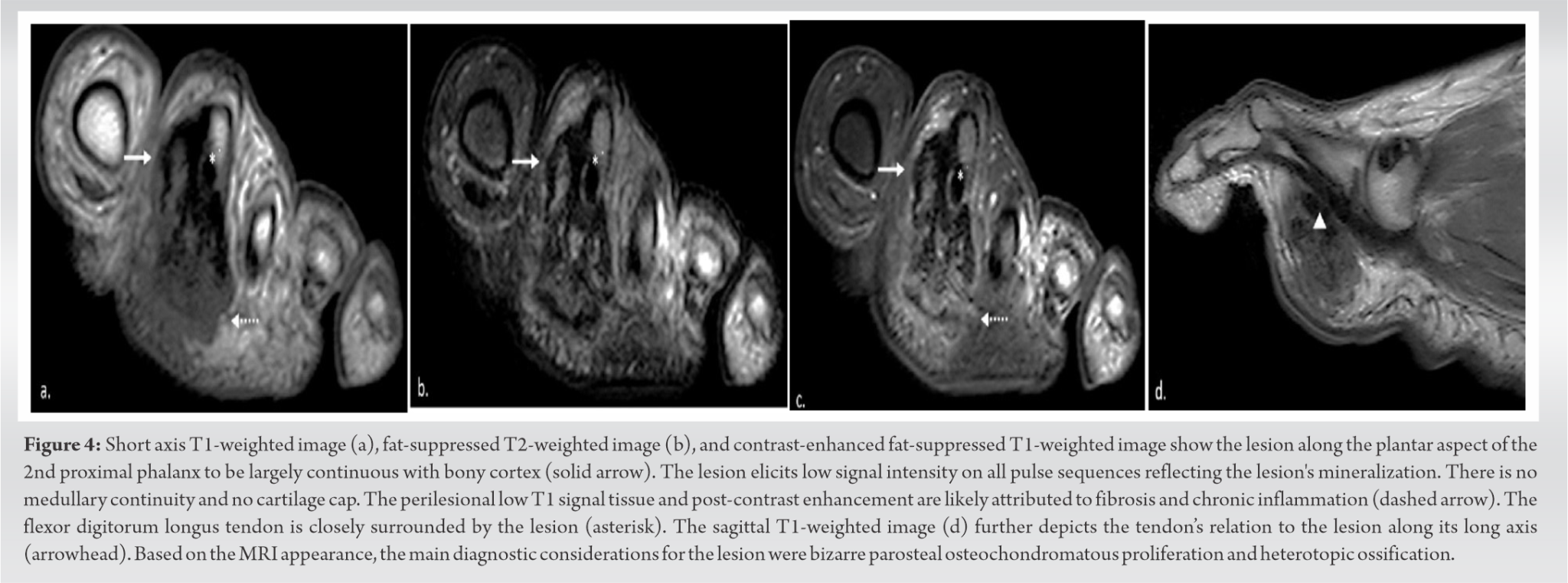 Bizarre Parosteal Osteochondromatous Proliferation (Nora’s Lesion) Of ...