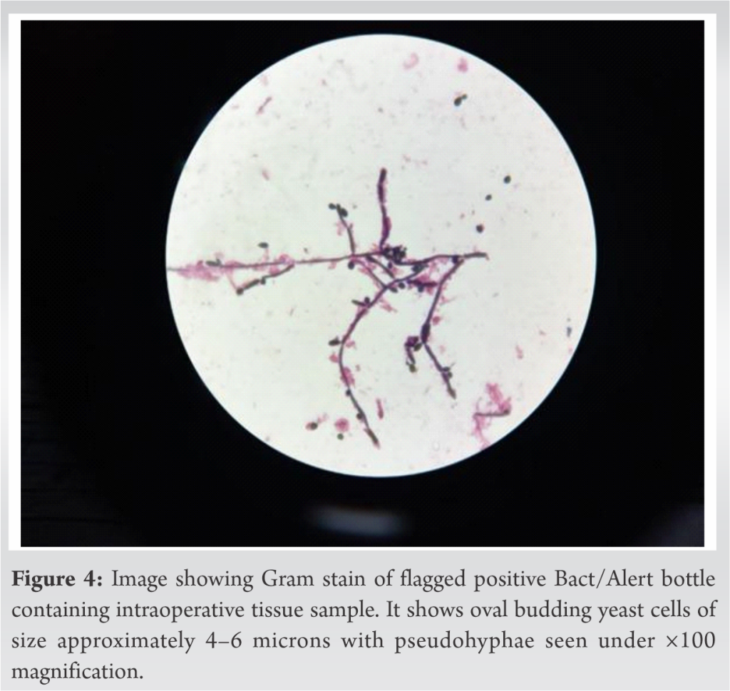 Peri-prosthetic Joint Infection due to Candida albicans in a Young ...